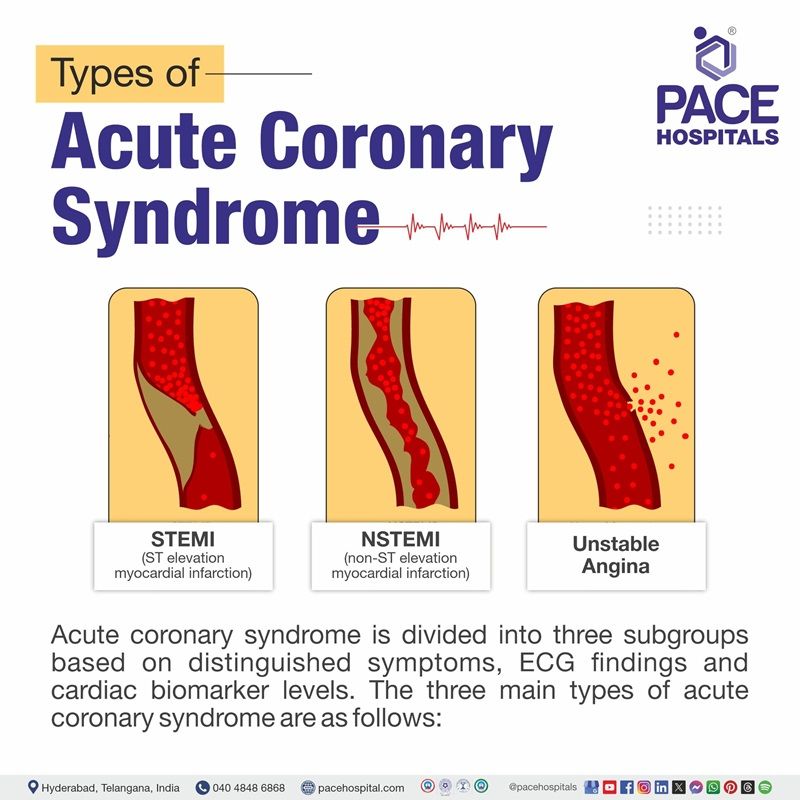 Acute Coronary Syndrome - Symptoms, Types, Causes & Treatment