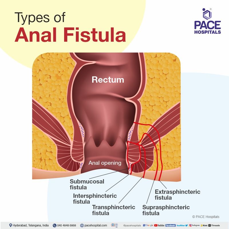 Anal fistula - Symptoms, Causes, Types, Complications, Prevention