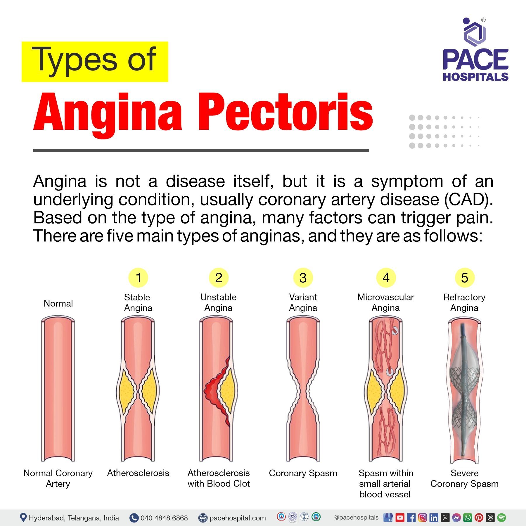 Angina Pectoris – Symptoms, Types, Causes & Treatment