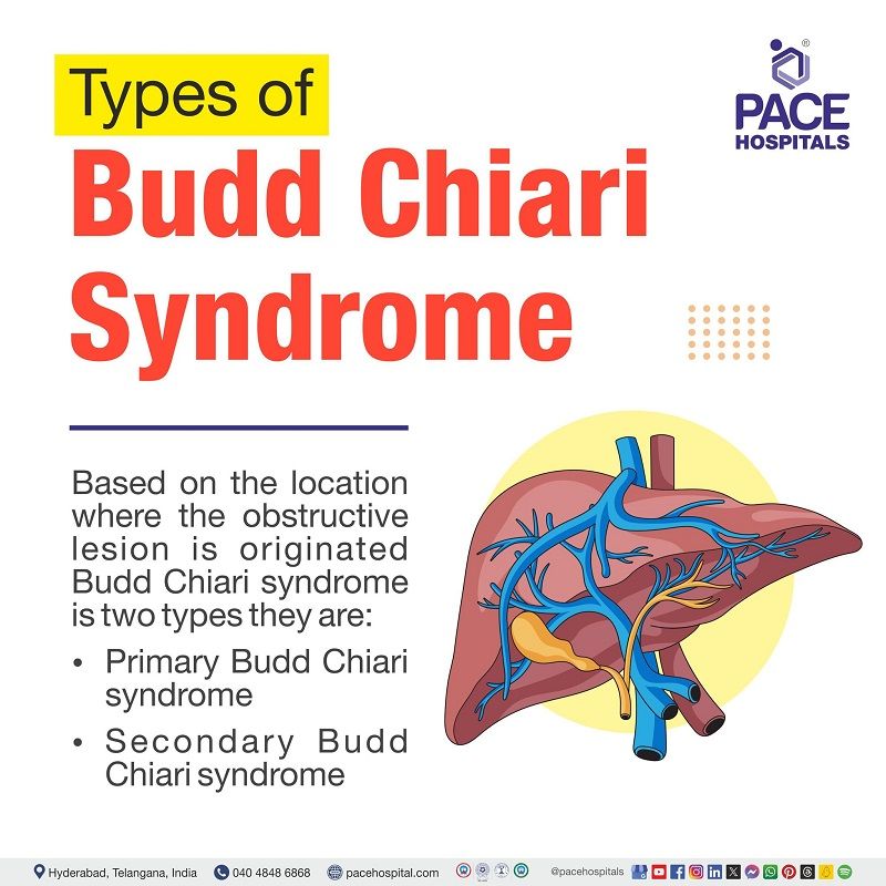 Budd-Chiari Syndrome - Symptoms, Causes, Types and Treatment