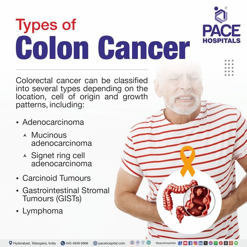 Colon Cancer: Types, Causes, Risk Factors, Symptoms & Treatment