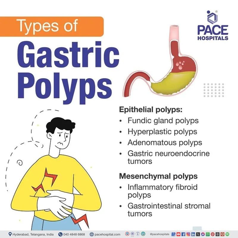 Gastric Polyps - Symptoms, Causes, Types, Treatment