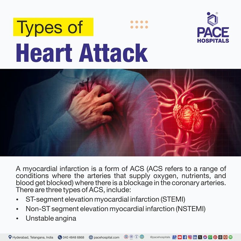 Heart Attack: Types, Symptoms, Causes, Treatment & Prevention