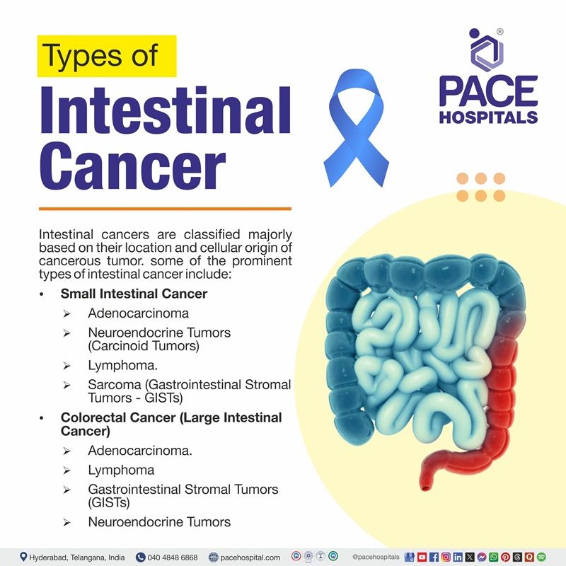 Intestinal Cancer: Symptoms, Causes, Diagnosis & Treatment