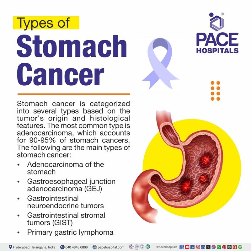 Stomach Cancer: Types, Symptoms, Causes, Treatment & Prevention