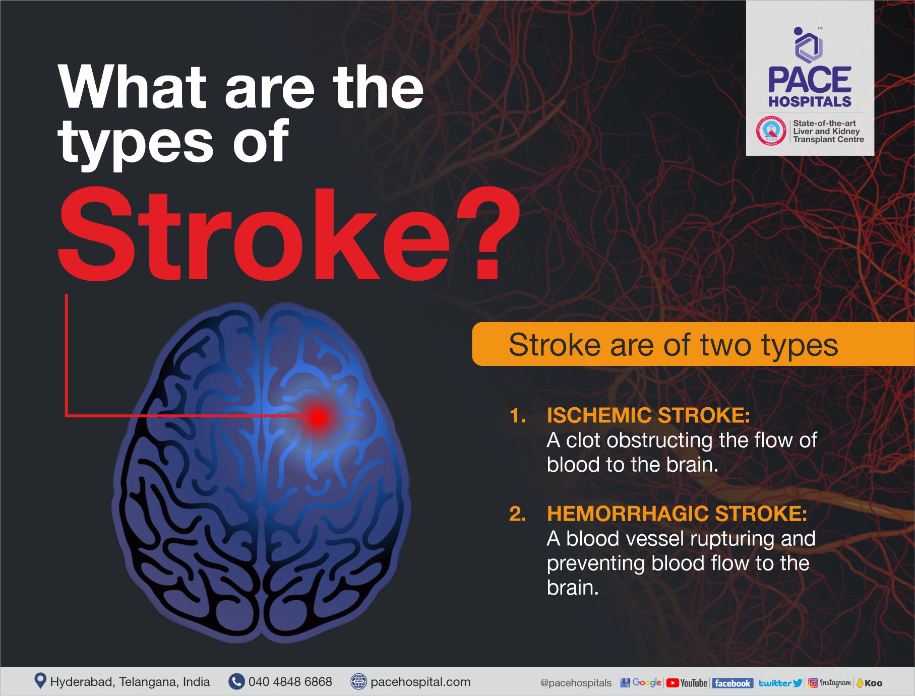 Stroke and Diet: An Indian Perspective—What to Eat, What to Limit