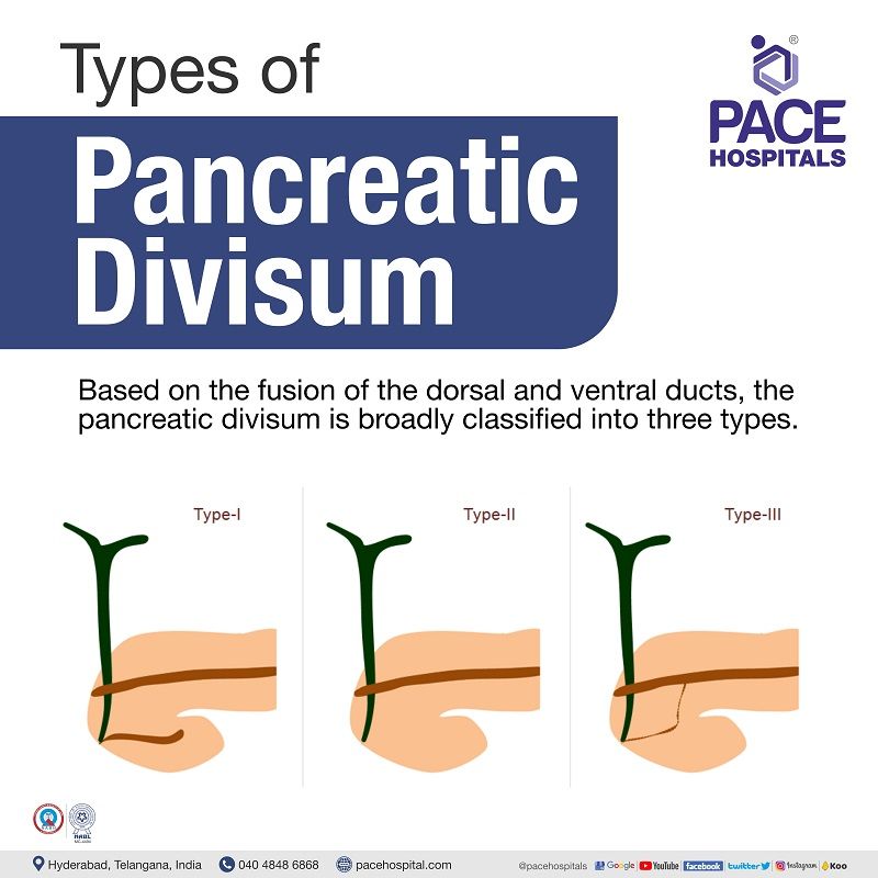 Pancreas Divisum - Symptoms, Causes, Types, Complications