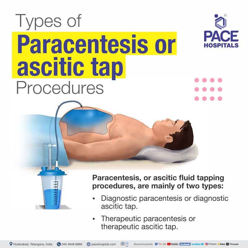 Paracentesis (Ascites Tapping) in Hyderabad, India | Indication & Cost