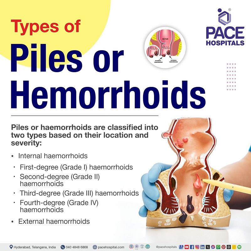 Piles (Hemorrhoids): Symptoms, Causes, Types and Treatment