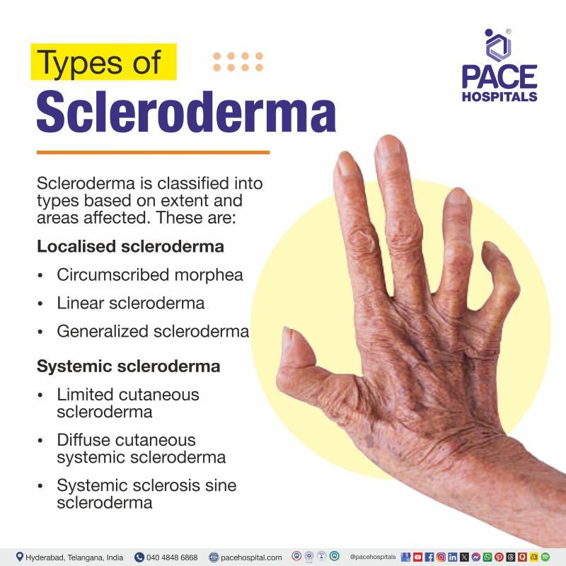 Scleroderma: Symptoms, Causes, Diagnosis & Treatment