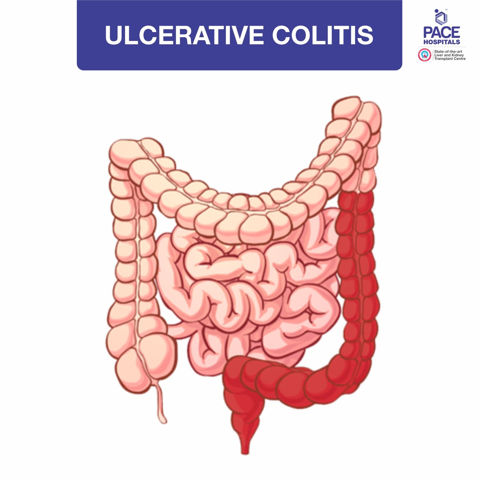 Best Inflammatory Bowel Disease Treatment Hospital in Hyderabad