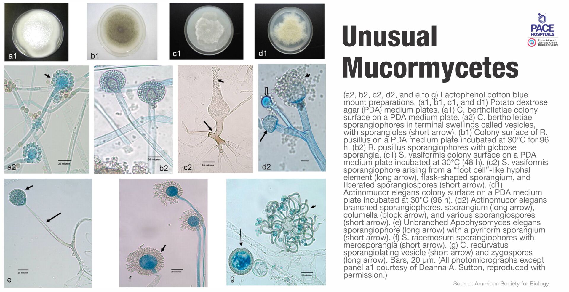 Black Fungus Infection Mucormycosis Disease: Symptoms & Treatment