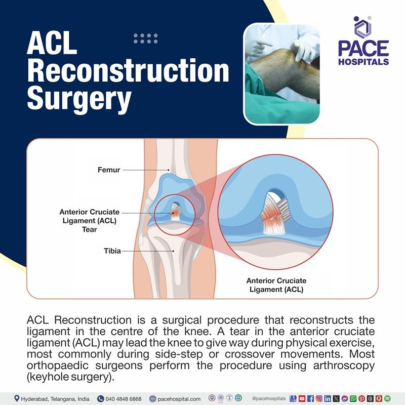 Best Hospital for ACL Surgery in Hyderabad | Cost & Success Rate