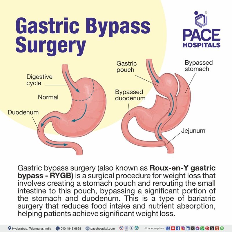 Best Hospital for Gastric Bypass Surgery in Hyderabad, India