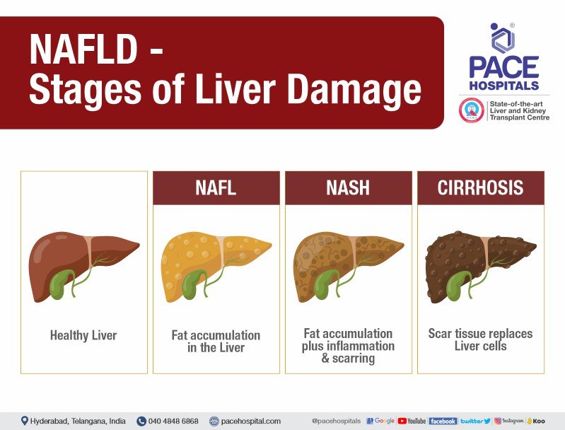 NAFLD & NASH - Symptoms, Causes, Differences & Treatment Options