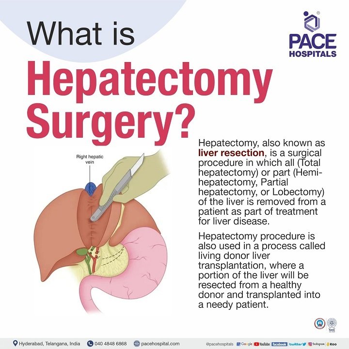 Hepatectomy Surgery In Hyderabad Types Procedure Indications And Cost