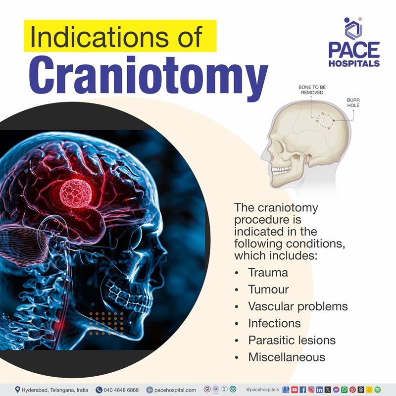 Best Craniotomy Procedure in Hyderabad, Cost & Benefits