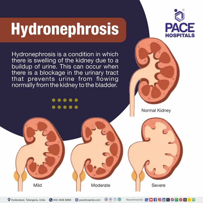 Hydronephrosis - Symptoms, Causes, Complications, Treatment