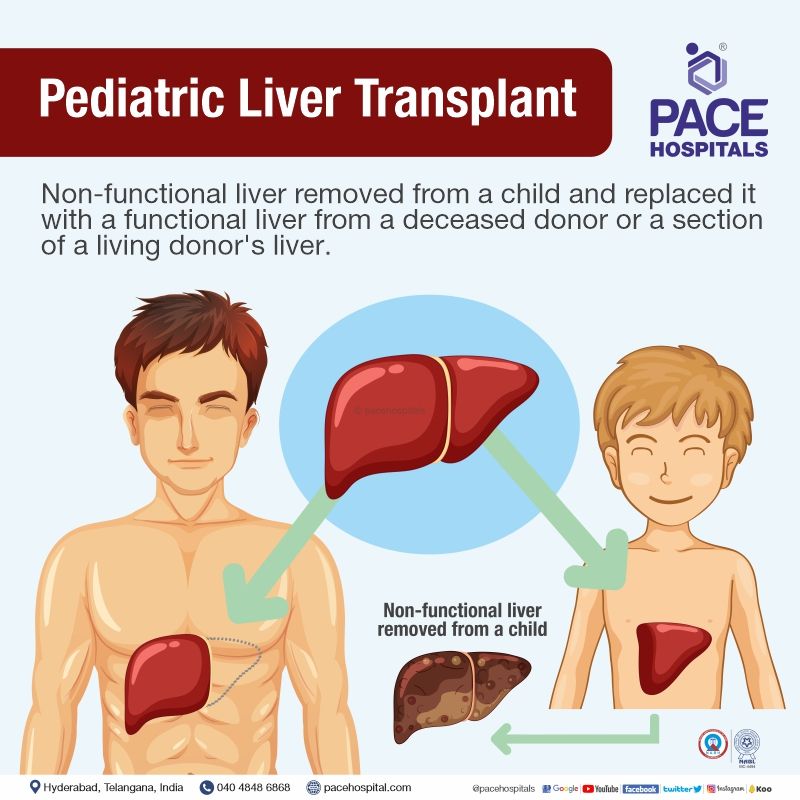 Best Hospital for Pediatric Liver Transplant in Hyderabad, India