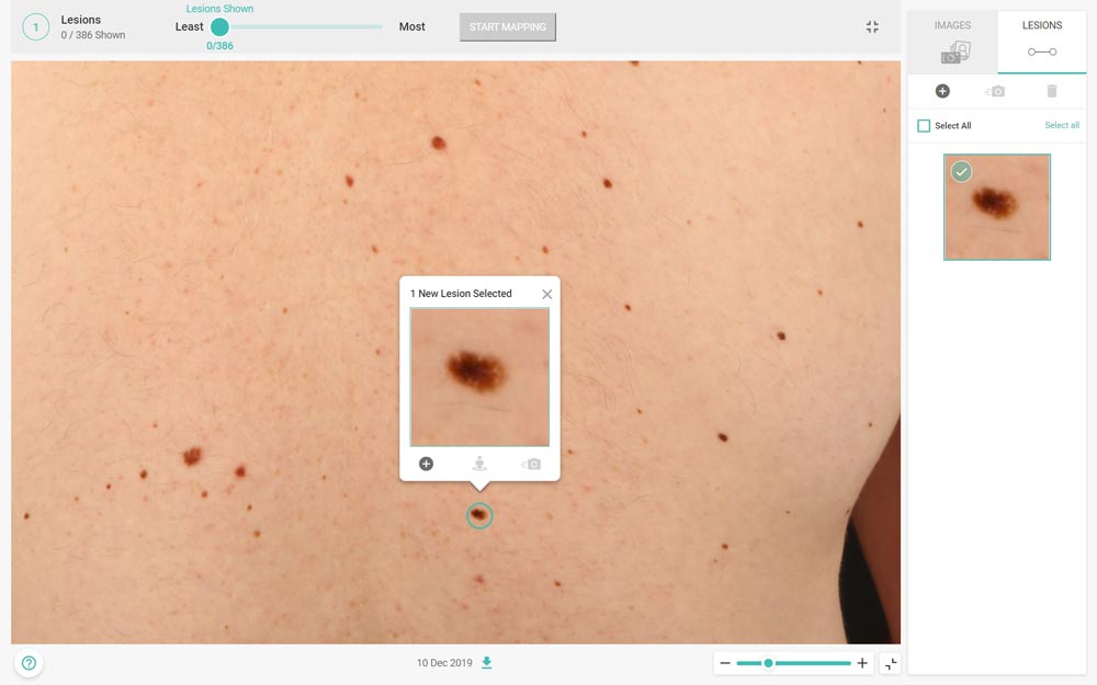 Mole Mapping - Skin Cancer Ballarat