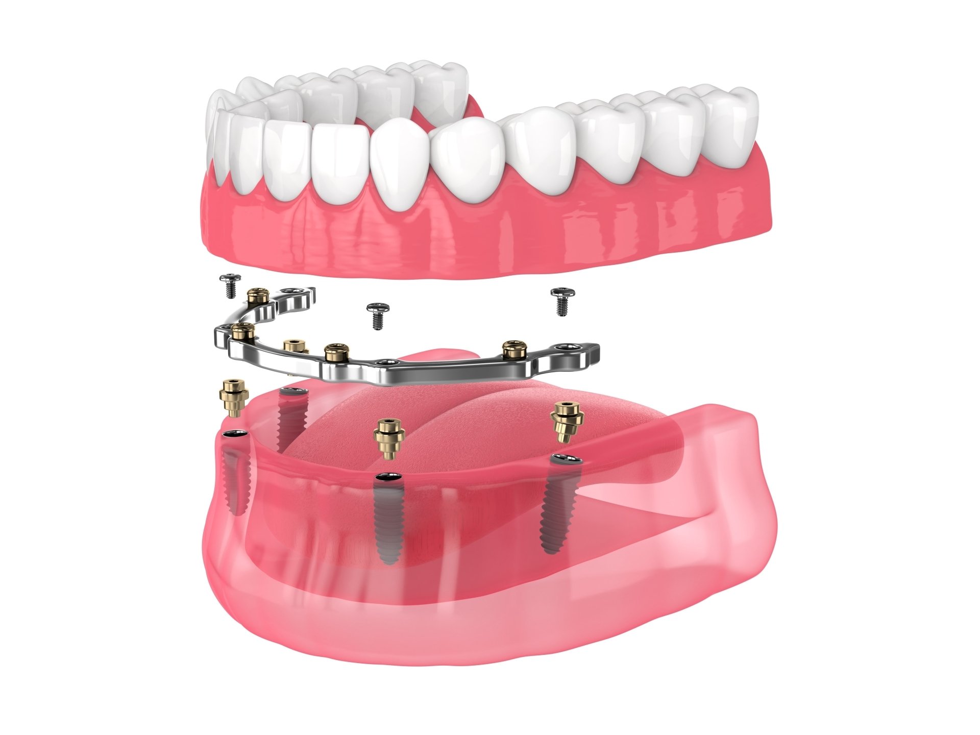 Types of Dentures | Dr. Joyce Cosmetic Dentistry | West LA Dentist
