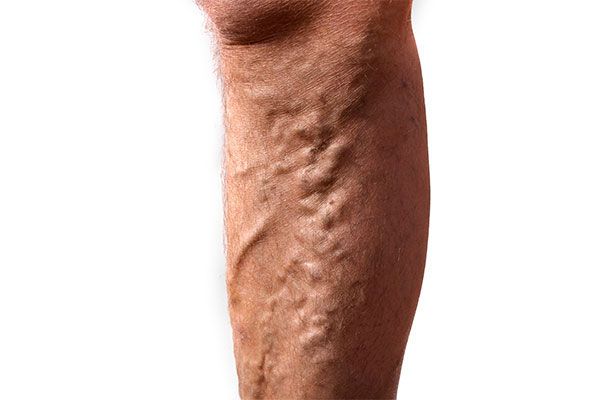 Tromboflebitis, síntomas y consecuencias