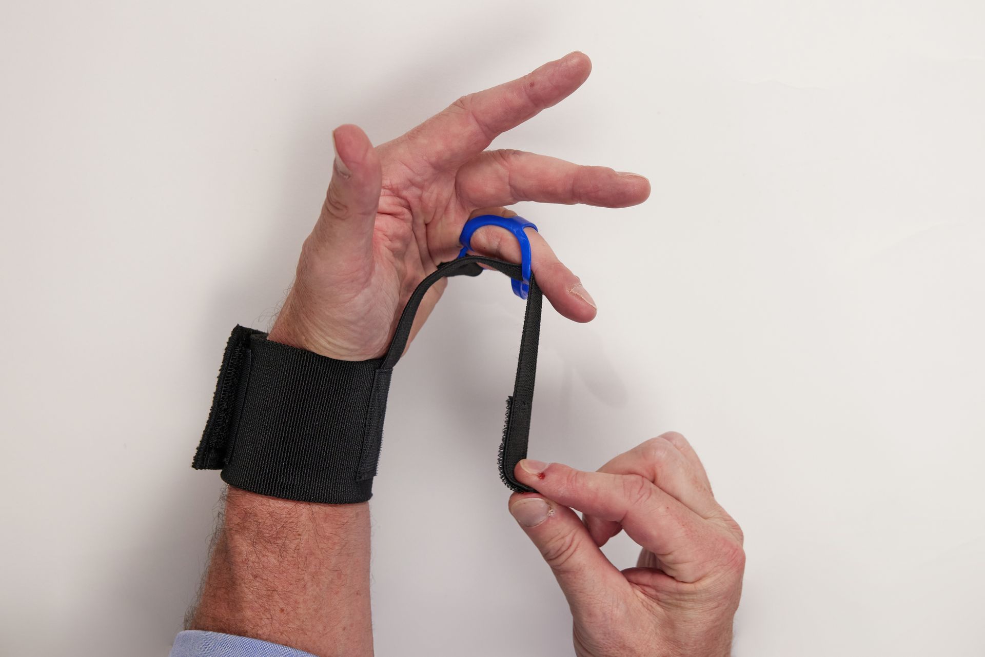 Boxer Fracture Repair | Irvine, CA | Perfect Fit Splints