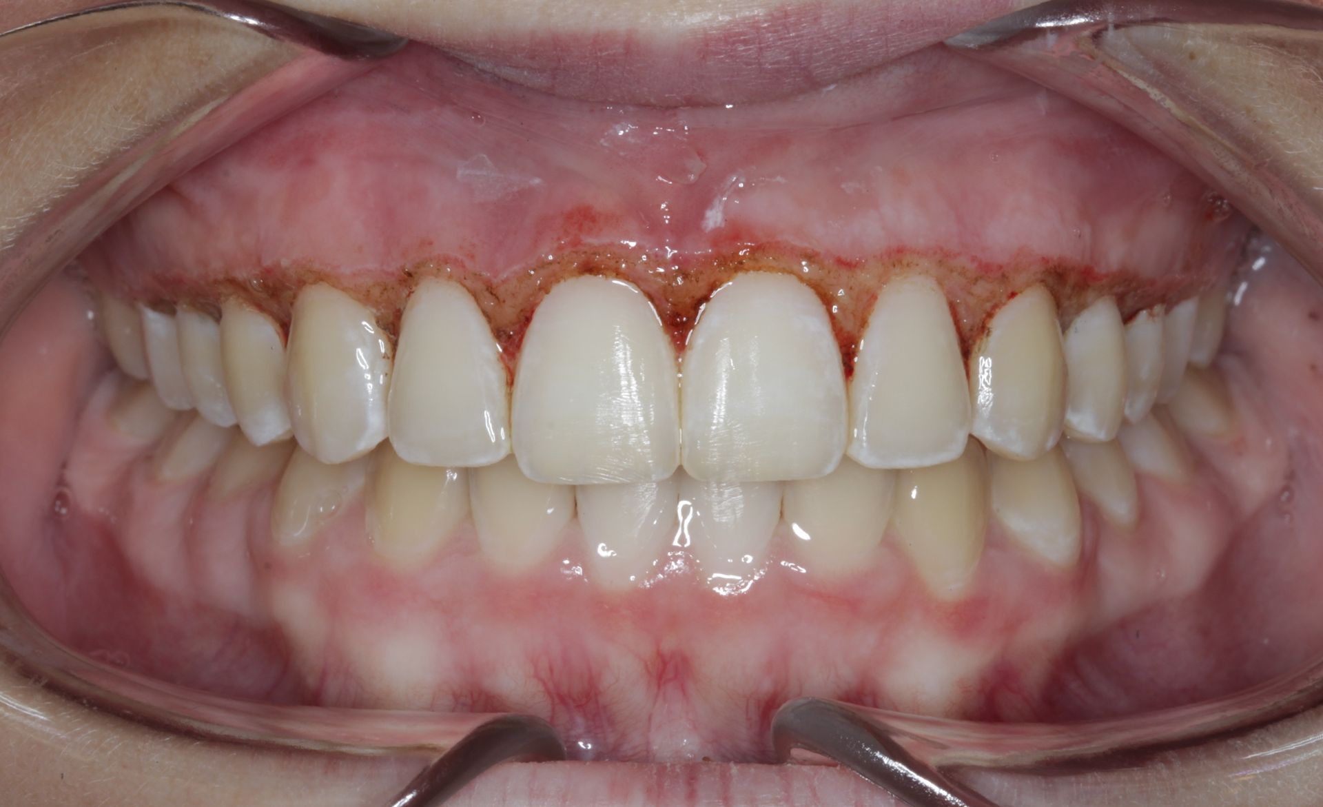 Gingivectomy El Paso, TX | Expert Care - Call (915) 201-0881