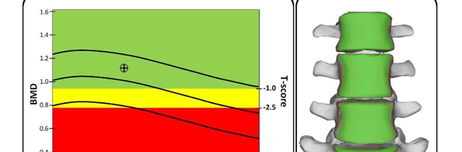 Understanding REMS: A New Era in Bone Health Assessment