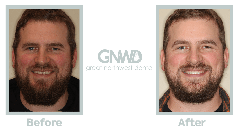 Invisalign Before/After