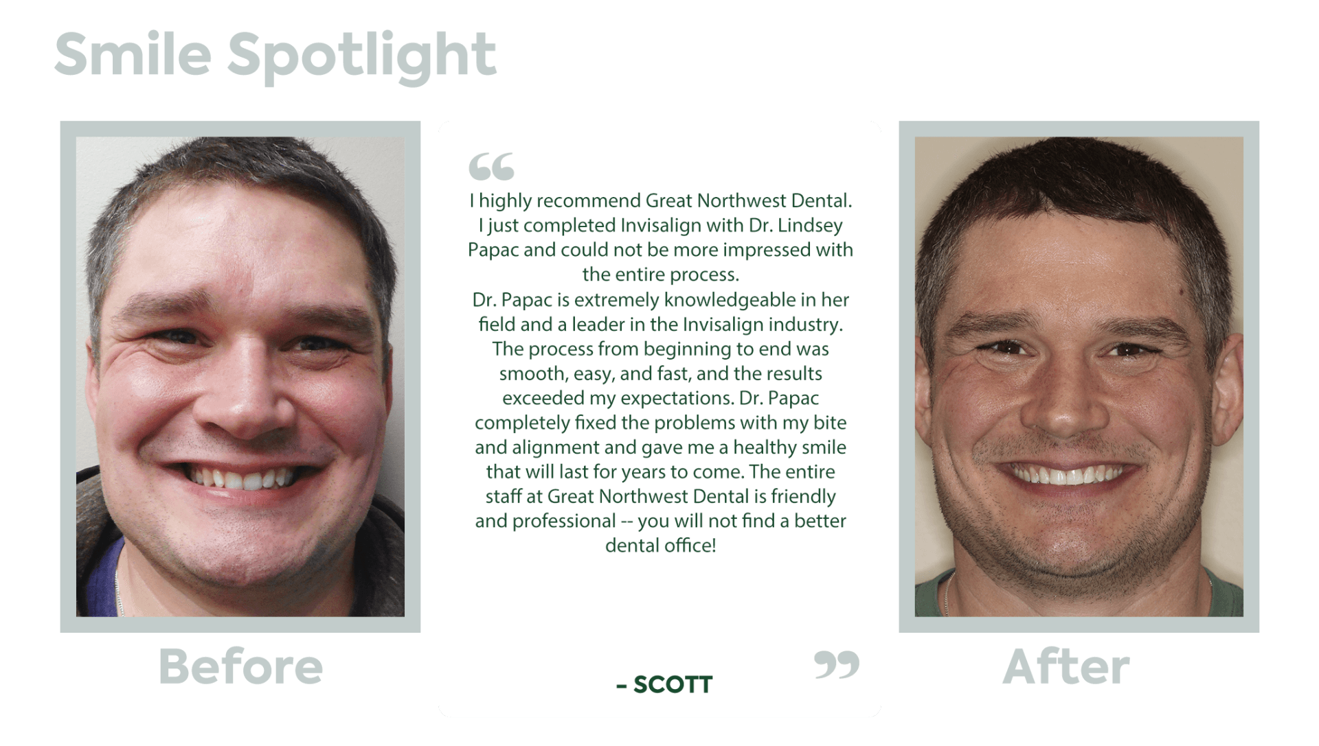 Invisalign Before/After