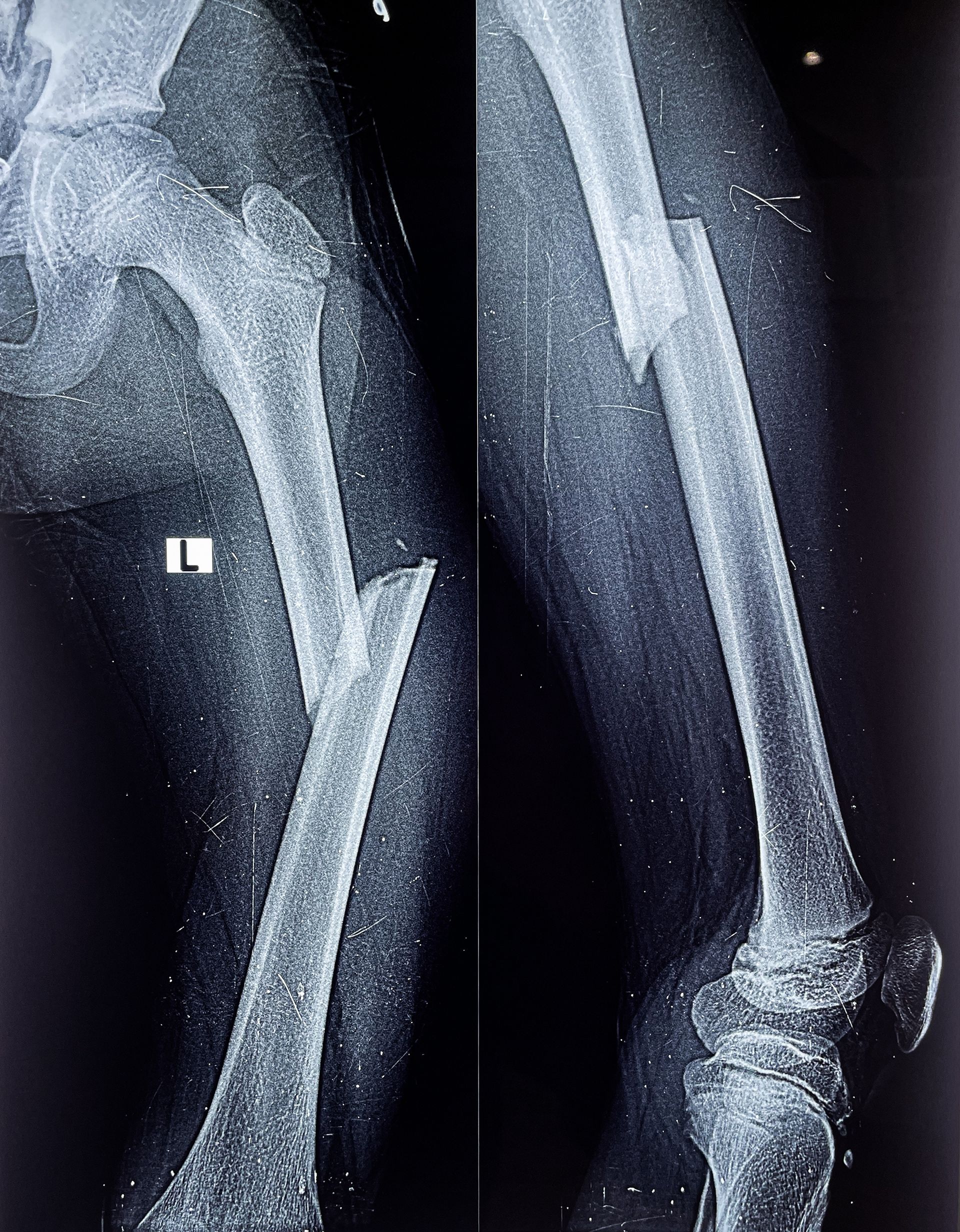 Femur Fractures