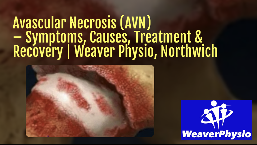Avascular Necrosis (AVN)