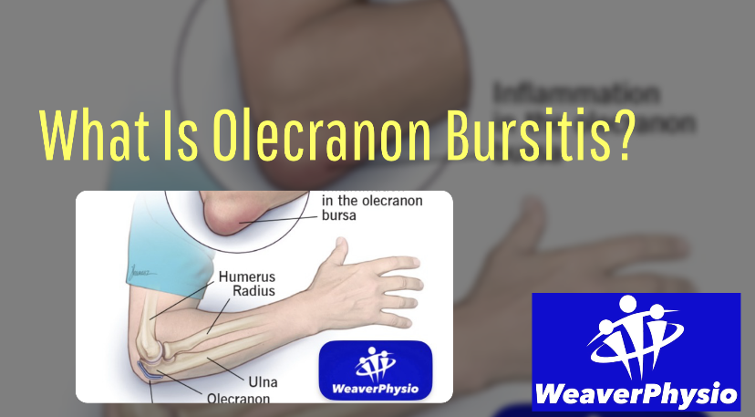 What Is Olecranon Bursitis?