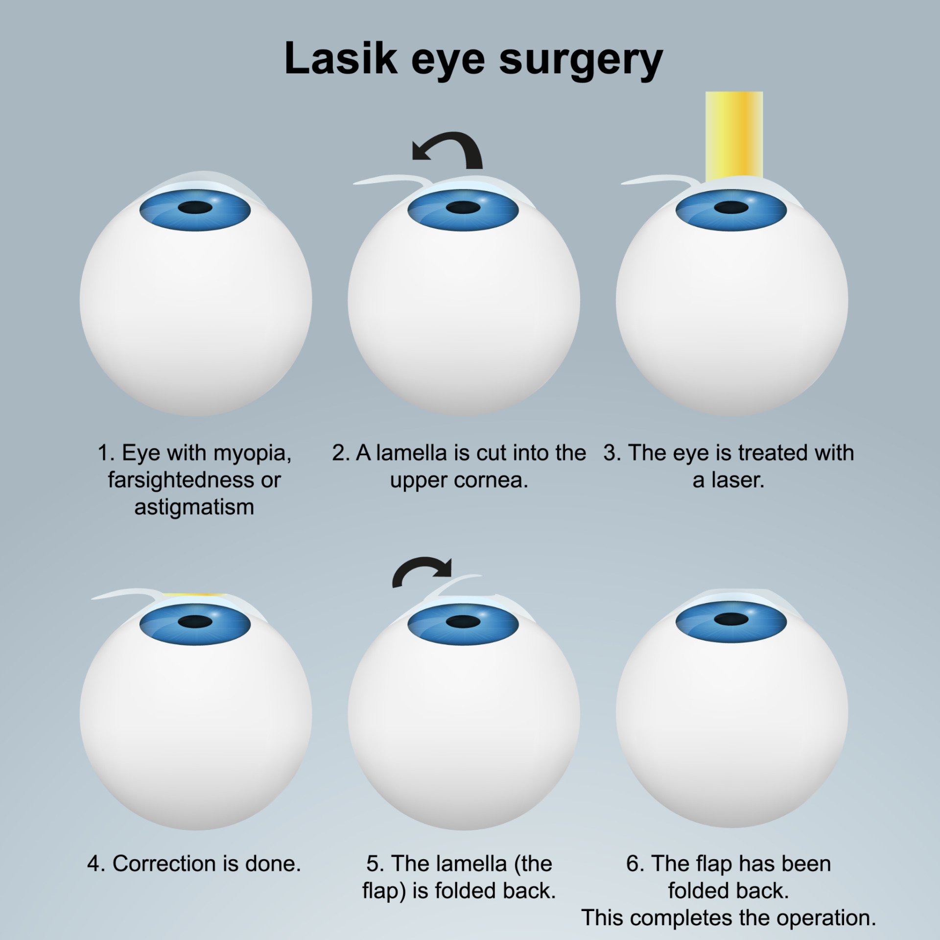 How Long Does LASIK Last?