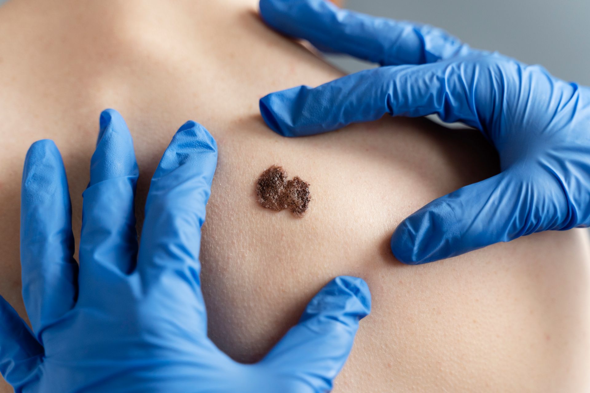 Mole Removal | Newmarket , ON | Dr. Health Cosmetic Clinic
