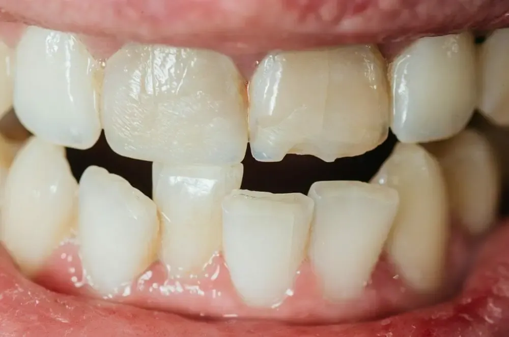 What Is Cracked Tooth Syndrome 