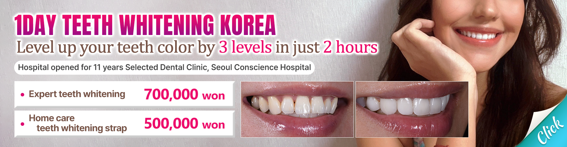 #1 Dental Veneers in Seoul, Korea | Foreigner-Friendly Gangnam Cosmetic ...