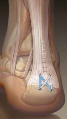 Achilles SpeedBridge | Dr Ben Beamond | Adelaide