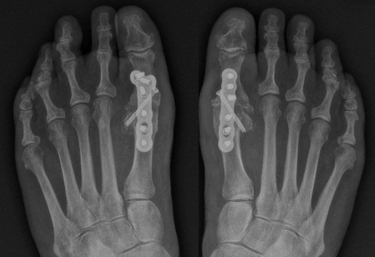 Big Toe (1st MTP) Fusion | Dr Ben Beamond | Adelaide