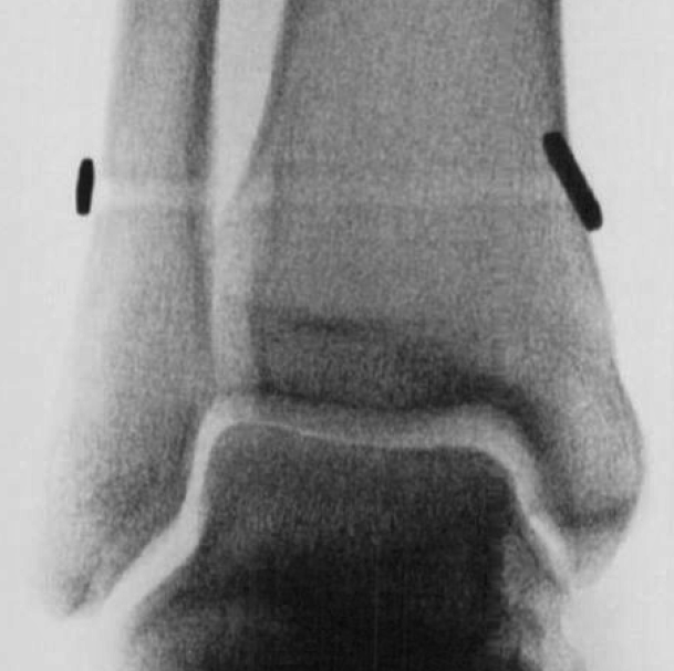 High Ankle Injury | Ankle | Dr Ben Beamond | Adelaide