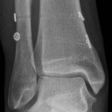 High Ankle Injury | Ankle | Dr Ben Beamond | Adelaide