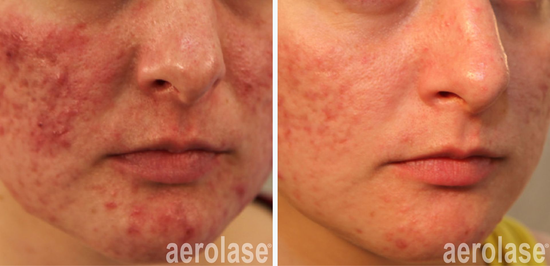 Before and After Gallery | Hiram, GA | Soft Life Medspa and Wellness