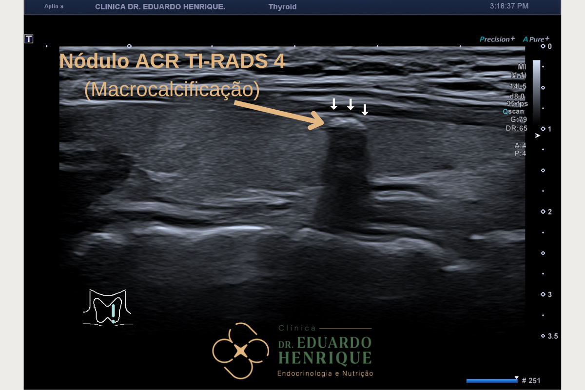 Especialista em Nódulo da Tireoide TIRADS 4 em São Paulo