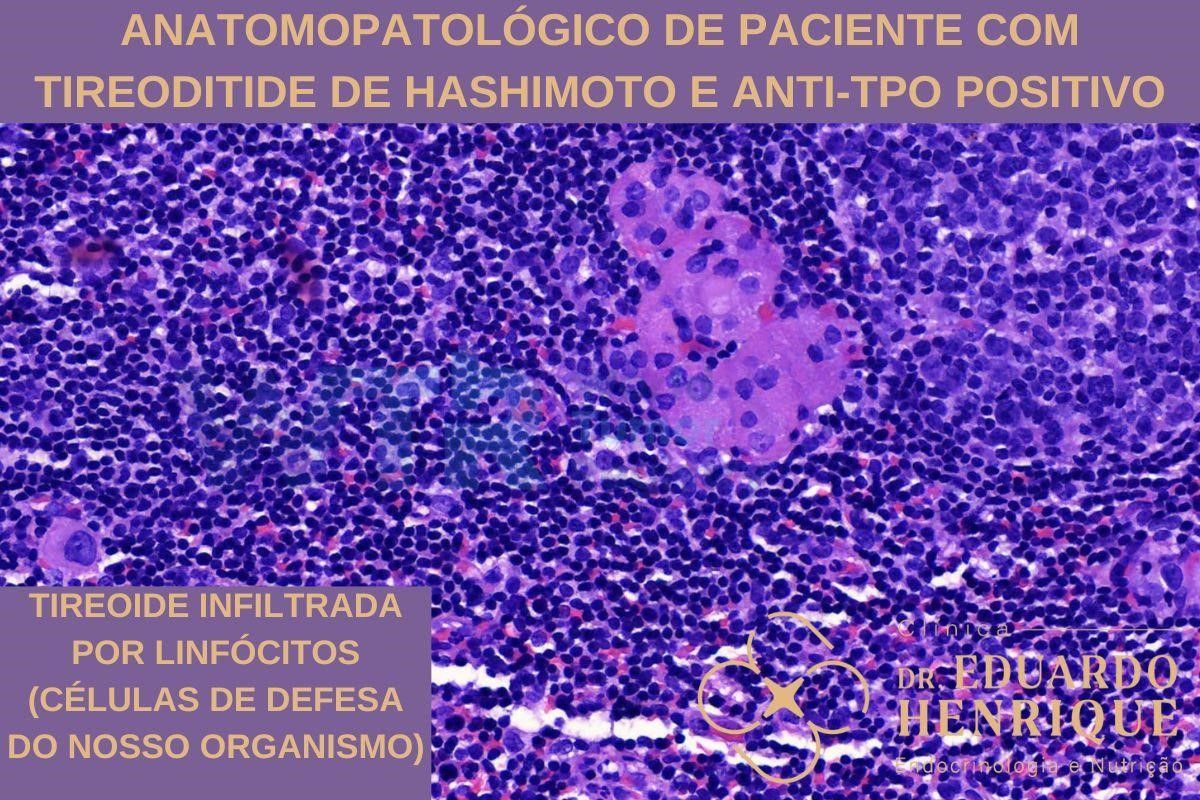 Exame de Anticorpos Antiperoxidase (Anti-TPO): descubra como ele pode ...