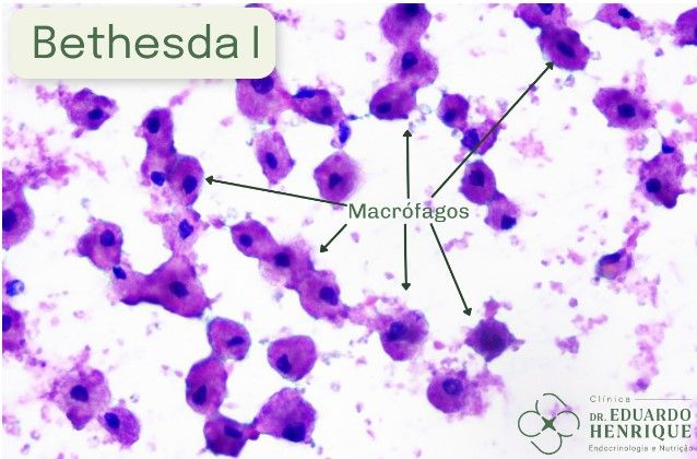 Biópsia da tireoide em São Paulo: Entenda os resultados do exame citológico