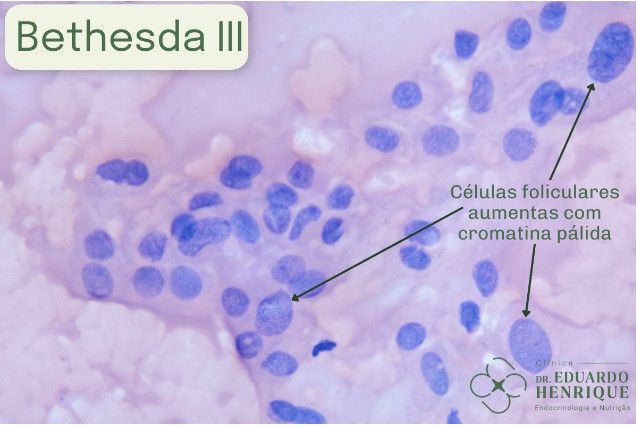 Biópsia da tireoide em São Paulo: Entenda os resultados do exame citológico