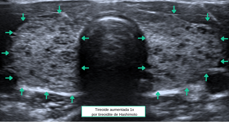 Bócio: entenda as causas e saiba como tratar