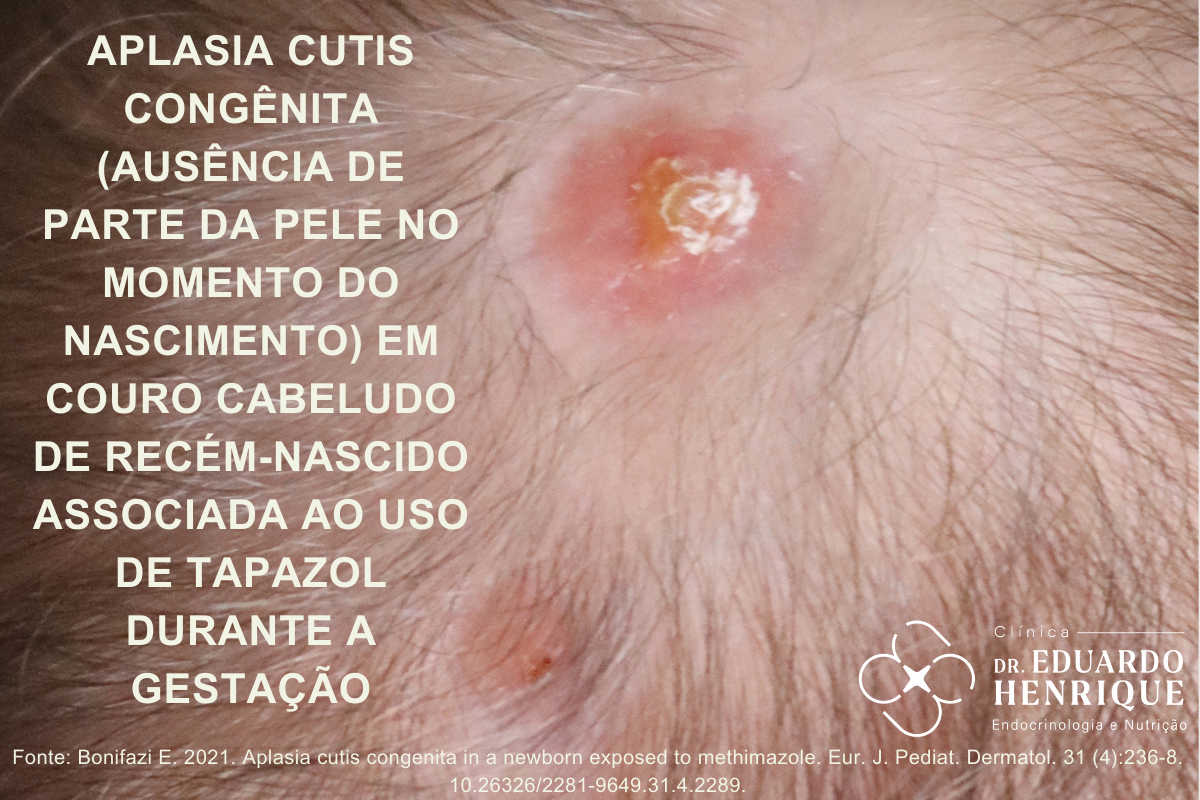 Tudo o que Você Precisa Saber Sobre o Tratamento com Tapazol ...