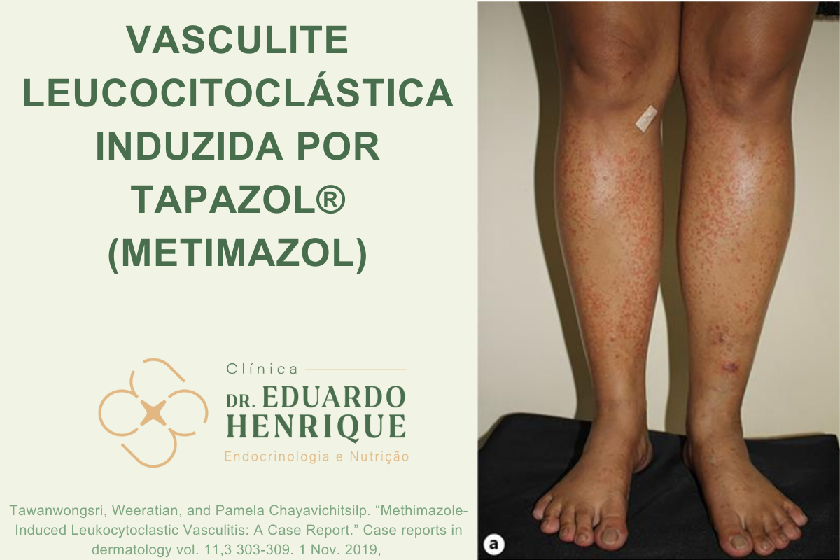 Tudo o que Você Precisa Saber Sobre o Tratamento com Tapazol ...